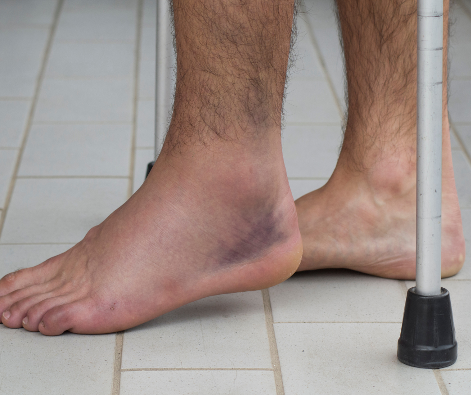 Sprained Ankle: Don’t Try to Walk It Off